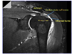 Shoulder Impingement Treatment Specialist Surgeon In Bangalore